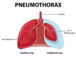 Collapsed Lung After a Car Accident: Symptoms and Treatment | Law ...