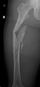 Comminuted Fractures: Recovering After a Car Accident | Law Offices of ...